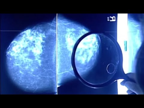 GRAIL is developing a new cancer screening test for 2021