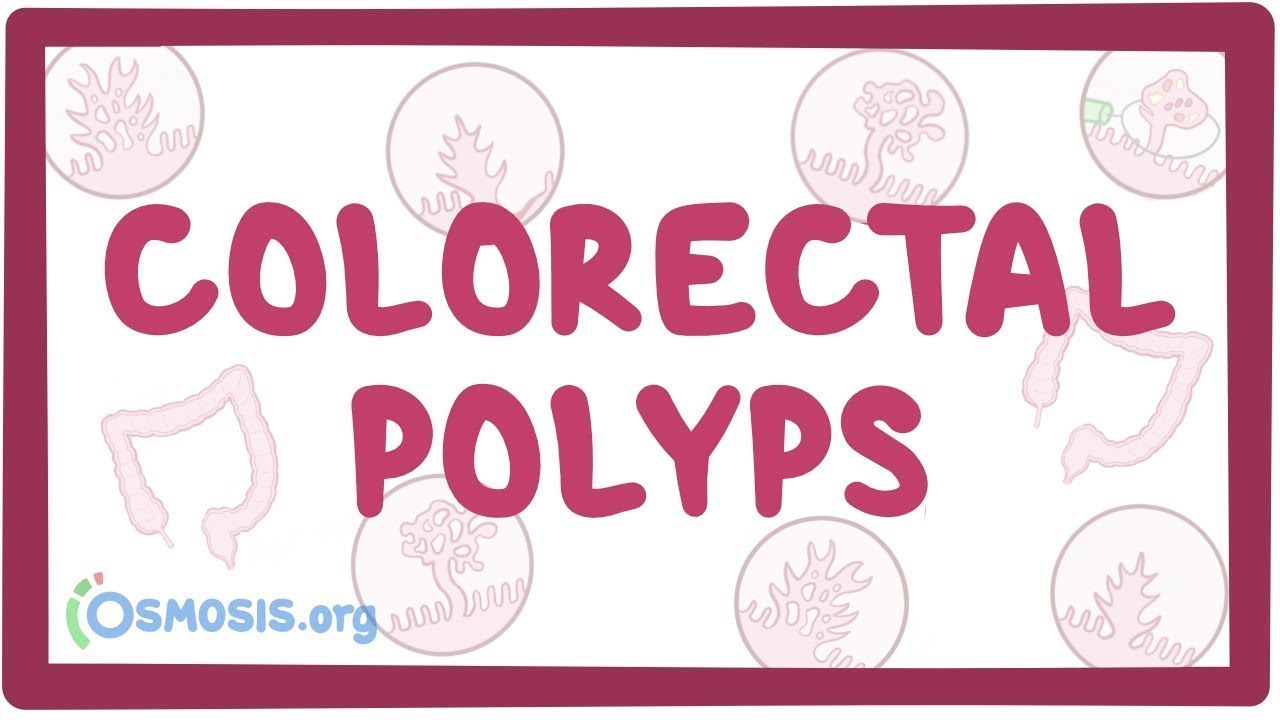 Colorectal polyps - an Osmosis Preview