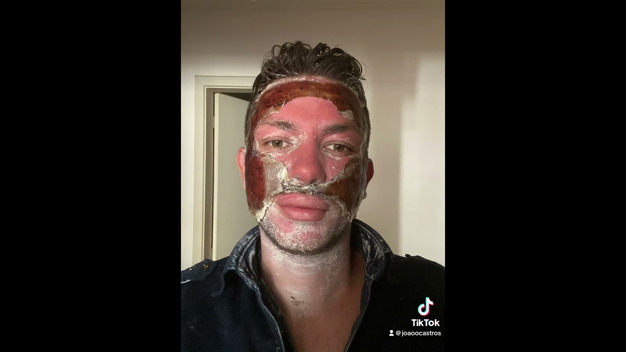 Cicatriz de Acne, TCHAU! Peeling de Fenol