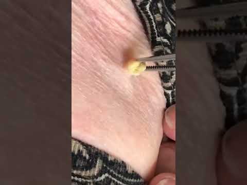 Who's had a big blackhead like this before and how did you get it removed?ā ā