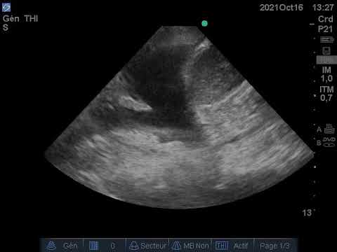 Epanchement pleural G Échographie