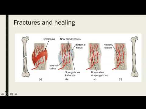 Bone Fractures and Repair