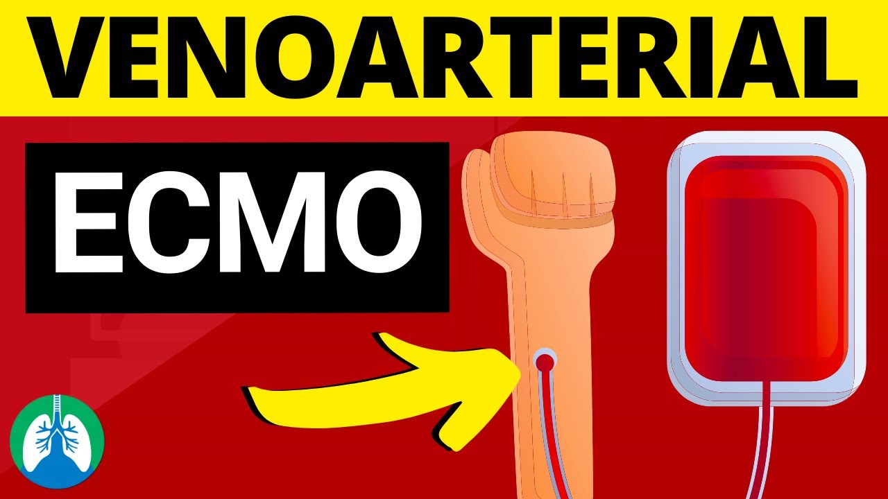 Venoarterial Extracorporeal Membrane Oxygenation (Medical Definition)