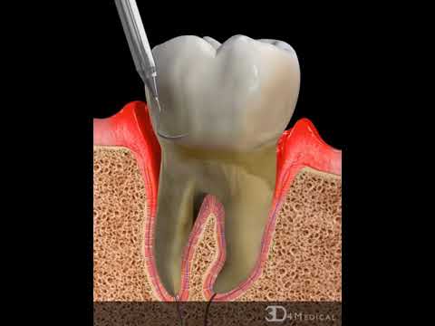 Periodontal Cleaning