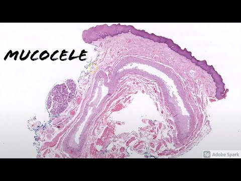 Mucocele of Lip (Mucous Extravasation Phenomenon): 5-Minute Pathology Pearls