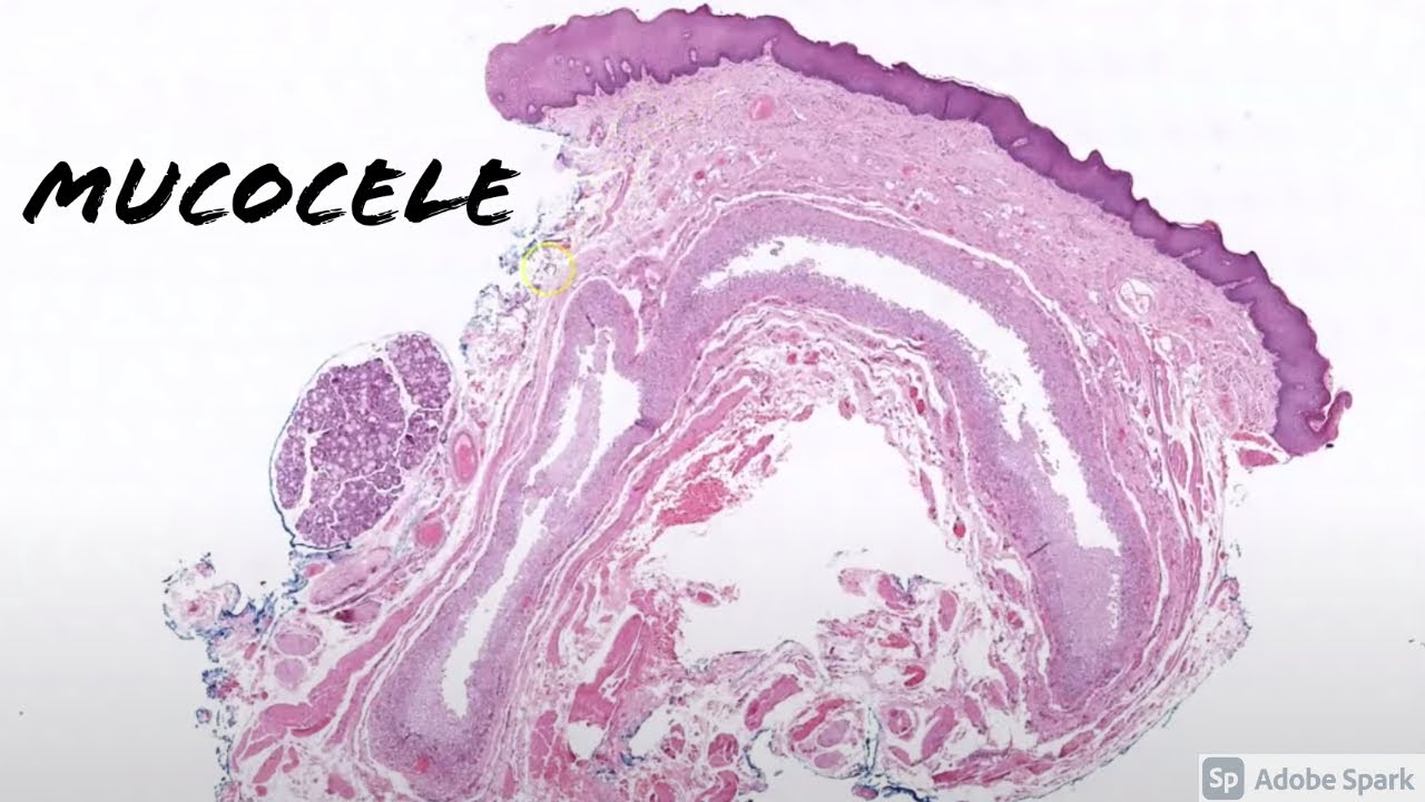 Mucocele of Lip (Mucous Extravasation Phenomenon): 5-Minute Pathology Pearls