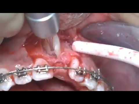 Tooth reimplantation 💯