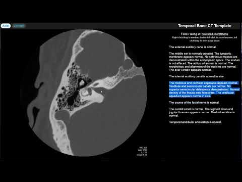 Radiology Walkthroughs - CT Temporal Bone Anatomy