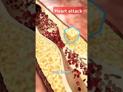 heart attack coronary artry blockage۔ #hearthealth