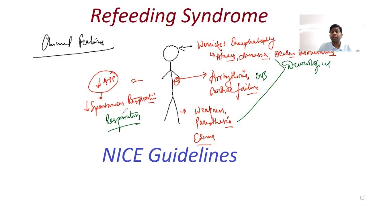 Understanding Refeeding Syndrome: Guidelines and Management | Galaxy.ai