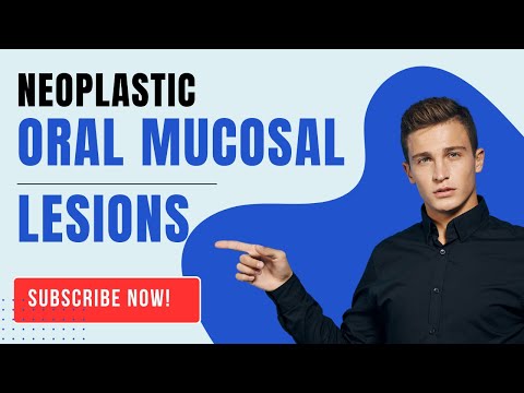 CANCEROUS ORAL MUCOSAL LESIONS....LIKE , COMMENT AND SUBSCRIBE ;--)