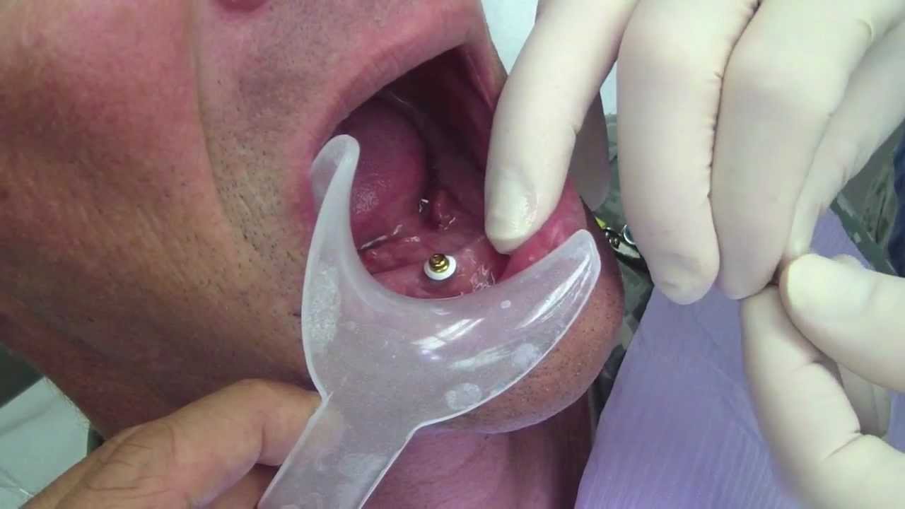 Locator Attachment Pickup (Implant Overdenture) - Dr. Dray