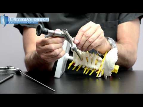 Endoscopic Treatment of Cervical Foraminal Stenosis