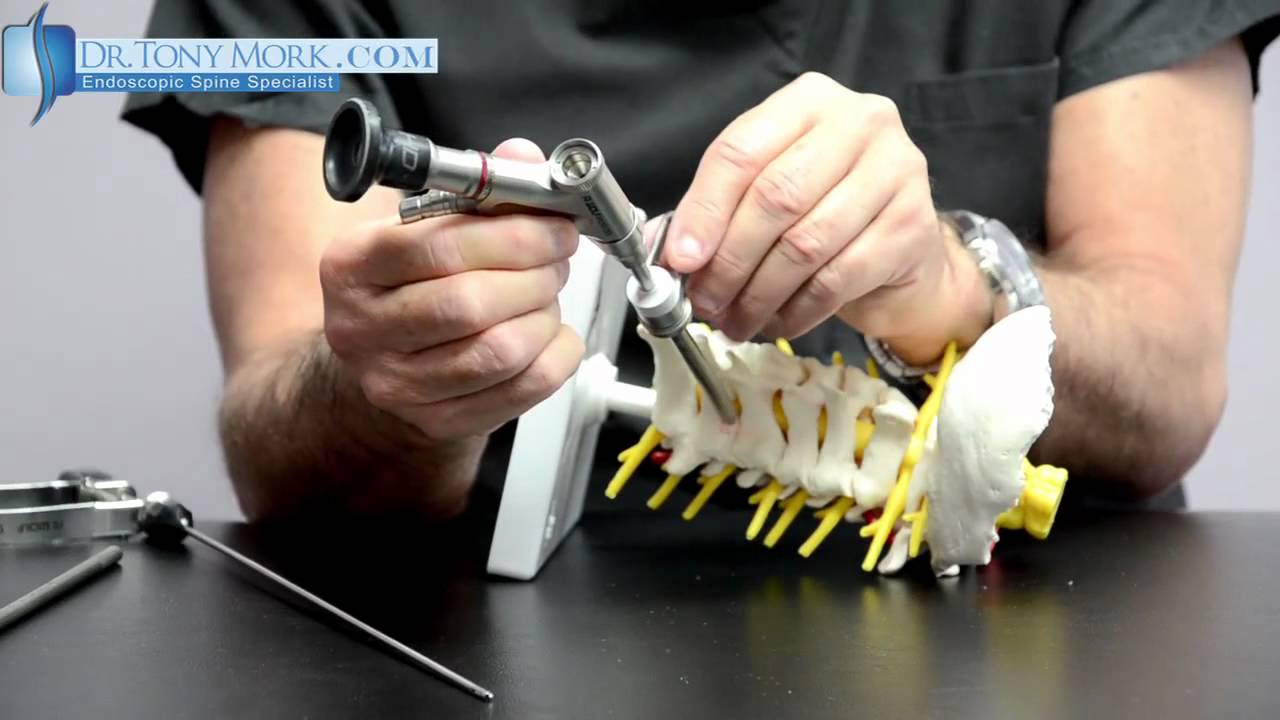 Endoscopic Treatment of Cervical Foraminal Stenosis