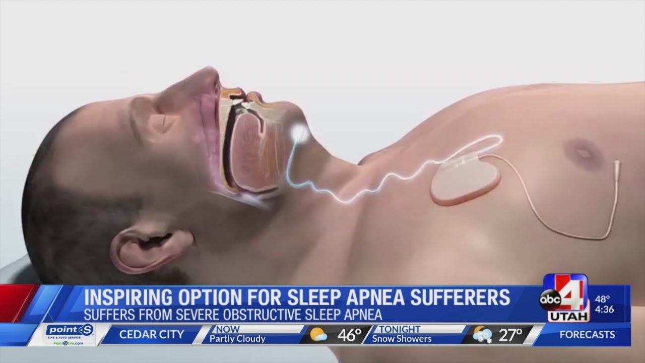 pacemaker device to cure sleep apnea