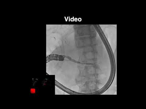 Endoscopic ultrasound-guided pancreaticoduodenostomy with a forward-viewing echoendoscope