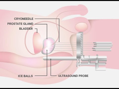 Cryosurgical ablation of the prostate CPT code - simplify medical coding