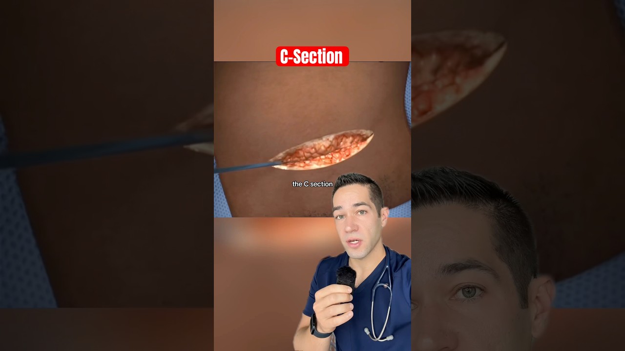 Doctor Explains: C section