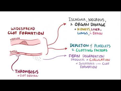 Disseminated intravascular coagulation causes symptoms diagnosis treatment pathology