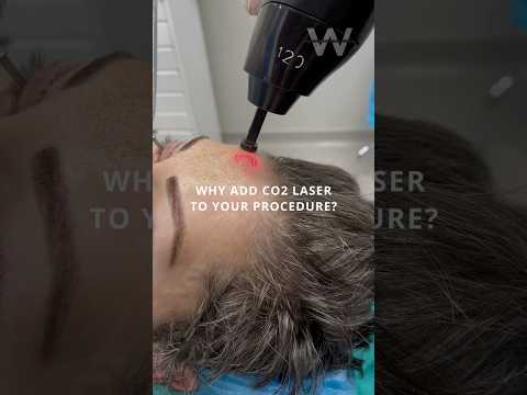 Why add CO2 Laser Skin Resurfacing to your next procedure? #lasertreatment