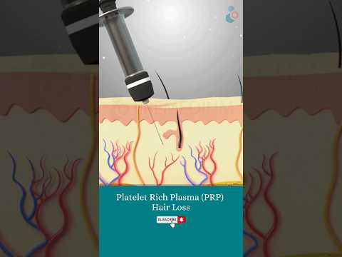 Platelet Rich Plasma and Its Use in Hair Regrowth ↪ 3D Medical Animation #Shorts #PRP #Hair #Health
