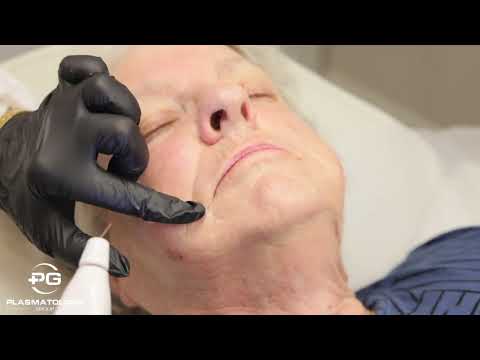 Cat Scratch Resurfacing With Plasma... Scratch years off your skin with Cat Resurfacing!