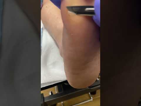 Incredible Transformation: Painful Foot Callus Removed by Podiatrist #FootCare #Podiatry