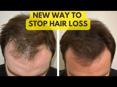 Scalp tension - The Real Cause of Male Pattern Baldness!
