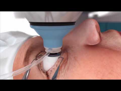 What is laser cataract surgery and is it better than traditional cataract surgery?