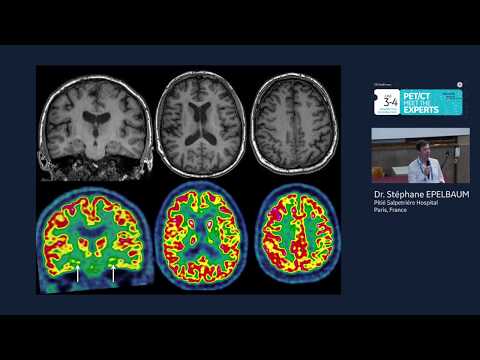 A neurologist's perspective on the benefits of digital PET imaging