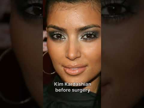 kim Kardashian before surgery and after #kimkardashian #beforeandafter #surgery