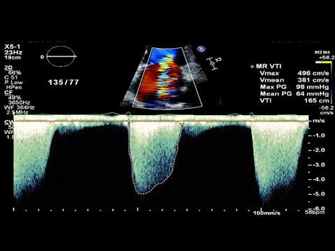 Quantifying mitral regurgitation using the PISA method