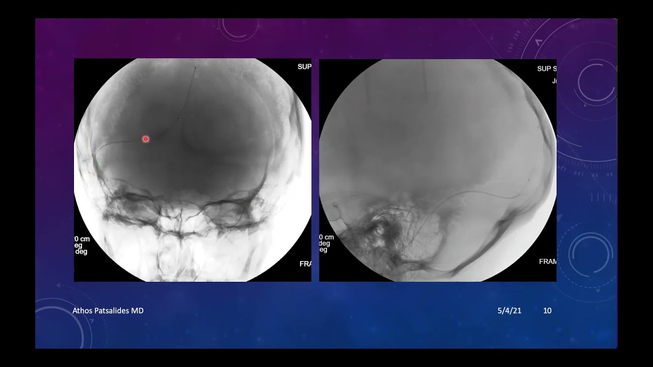 Venous Sinus Stenting