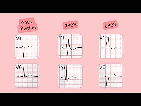 Sinus Rhythm, LBBB & RBBB - Explained Separately with Real Examples