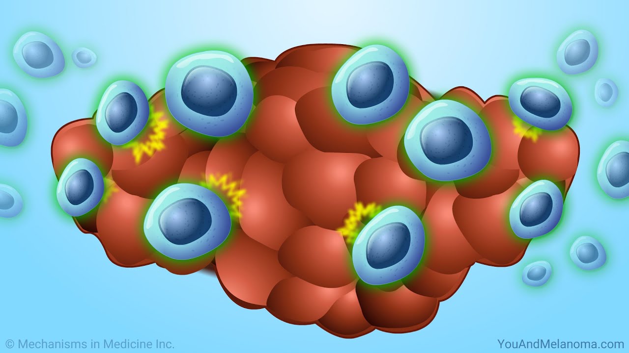 Tumor Infiltrating Lymphocyte (TIL) Cell Therapy in Melanoma