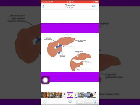 Case 067 morphological changes in liver cirrhosis