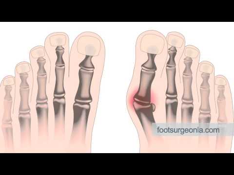 Bunions - Joseph K. Park DPM