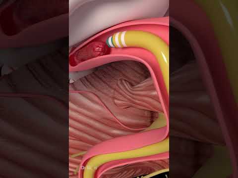 How Are Blood Clots Removed