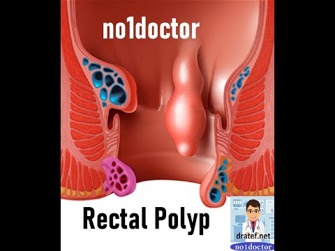 Rectal Polype/Causes/Signs and Symptoms/ Diagnosis and Treatment/colorectal/surgery/polypectomy/frcs