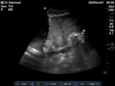 Case 89 : Hyperechoic liver lesions