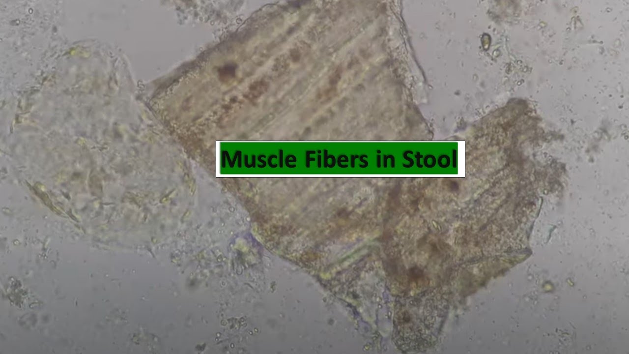Muscle Fibers in Stool