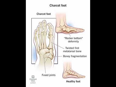Charcot foot/rocker bottom deformity #viral #trending #youtubeshorts #fitness #tips #medical