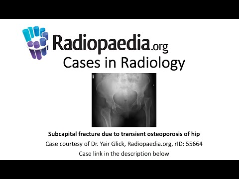 Subcapital fracture due to transient osteoporosis of hip (Radiopaedia.org) Cases in Radiology