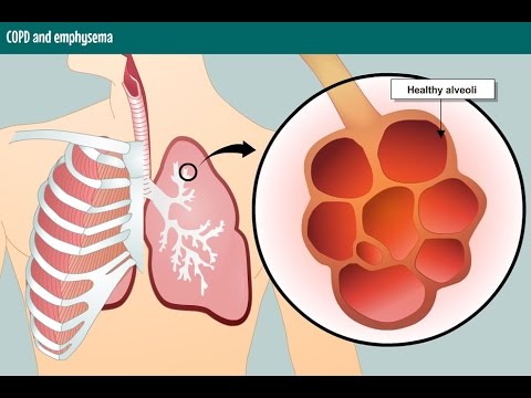 COPD and emphysema