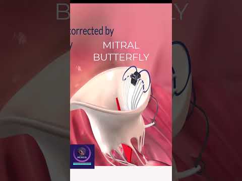 Mitral Valve Regurgitation - Corrected by Mitral Butterfly