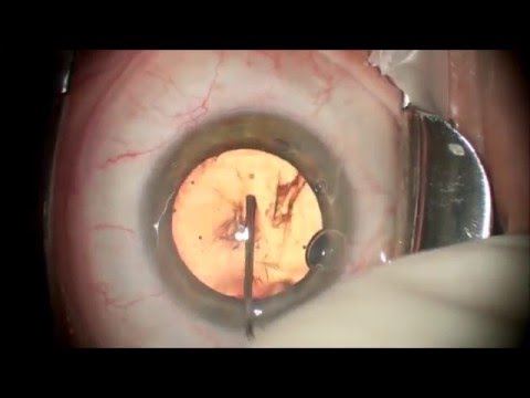 Istent Phaco and IOL (Cataract)- Real time Full case. Efficient surgery. San Antonio Glaucoma.