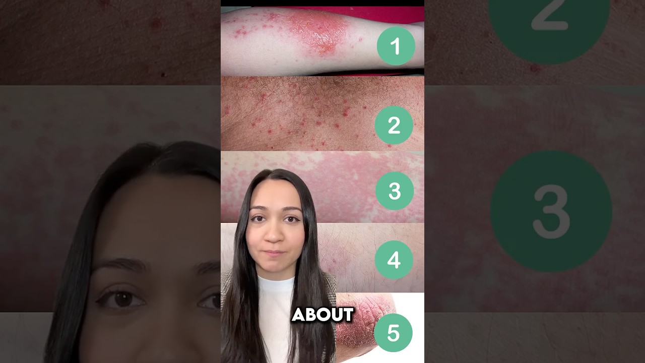 5 Common Skin Rashes to Know About #shorts