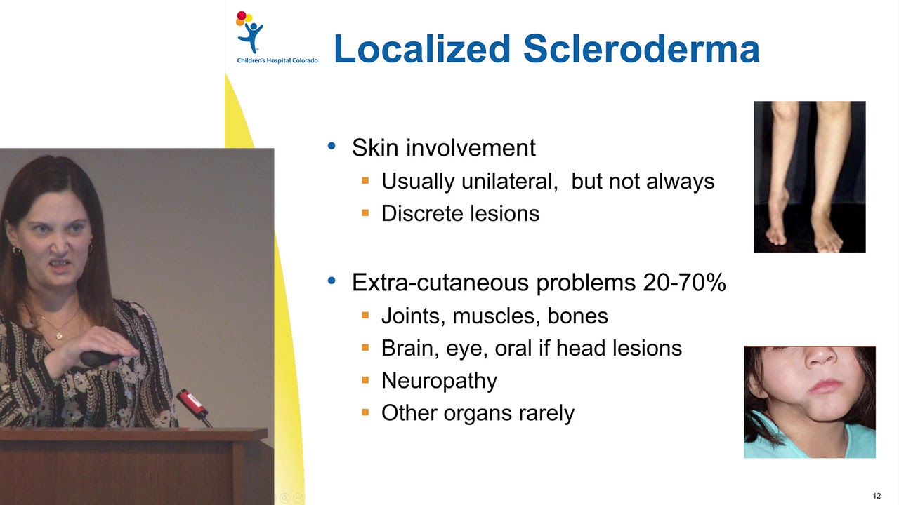 Scleroderma 101 - 2018 Patient Education Day