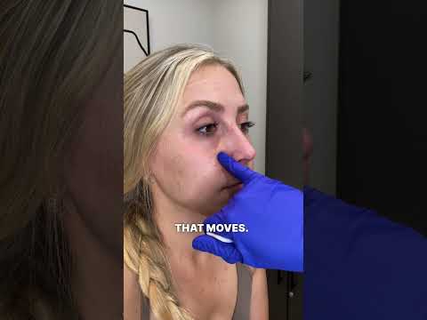Tear Trough Filler | The Solution To Dark Circles and Under Eye Hollows