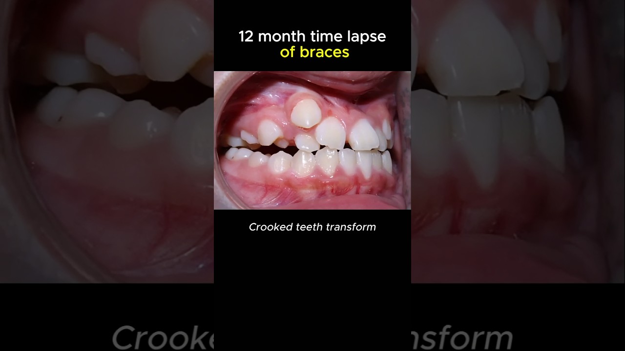 Braces time lapse - 12 months for crooked teeth #braces #dentist #orthodontist